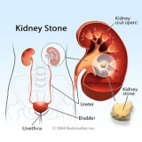First aid for Kidney Stones - First Aid for Free