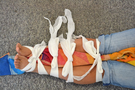A guide to splinting and immobilization - First Aid for Free