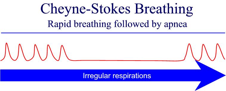 What is Cheyne-Stokes Respiration? - First Aid for Free