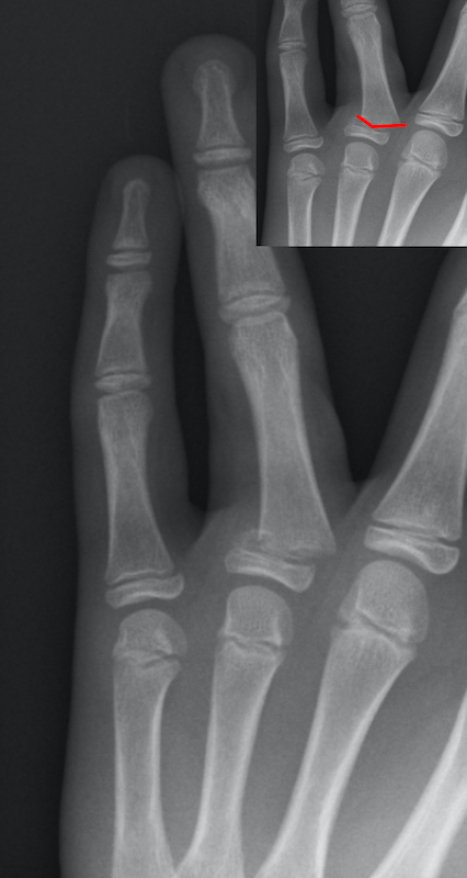 How to Tell if Your Finger is Broken: Fractures, Sprains, and ...