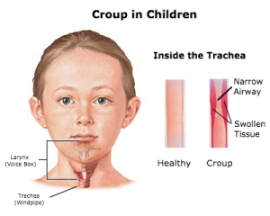 What is Croup in Children and Babies? - First Aid for Free
