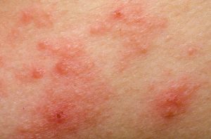 Eczema in Babies and Children - First Aid for Free
