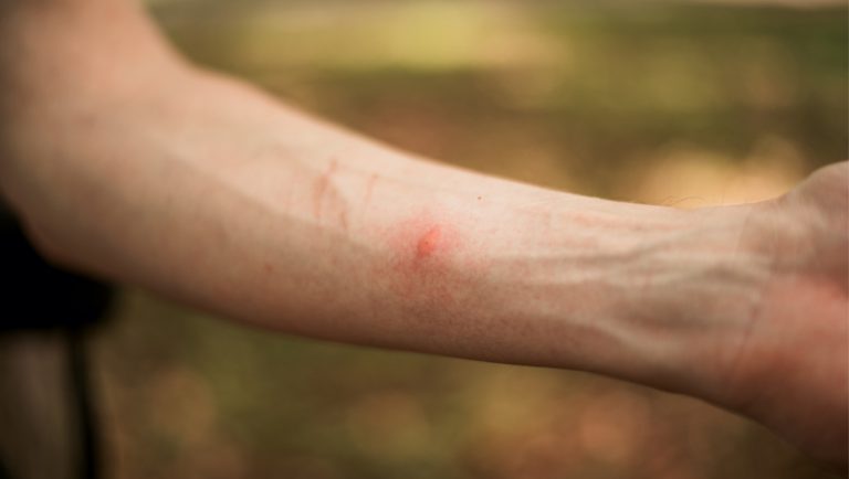 Treating Bites and Stings in Children - First Aid for Free
