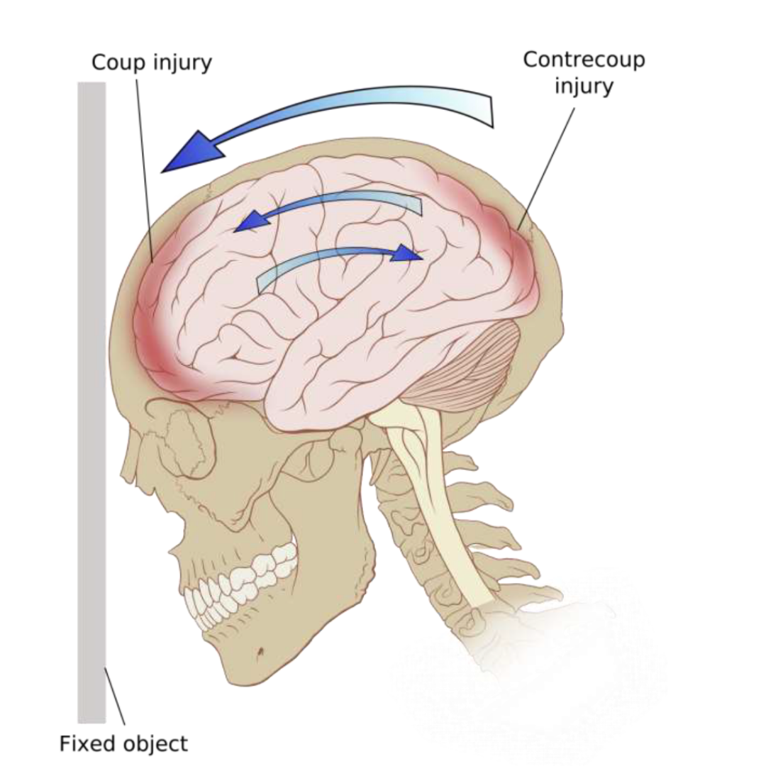 Primary vs Secondary Brain Injuries - First Aid for Free