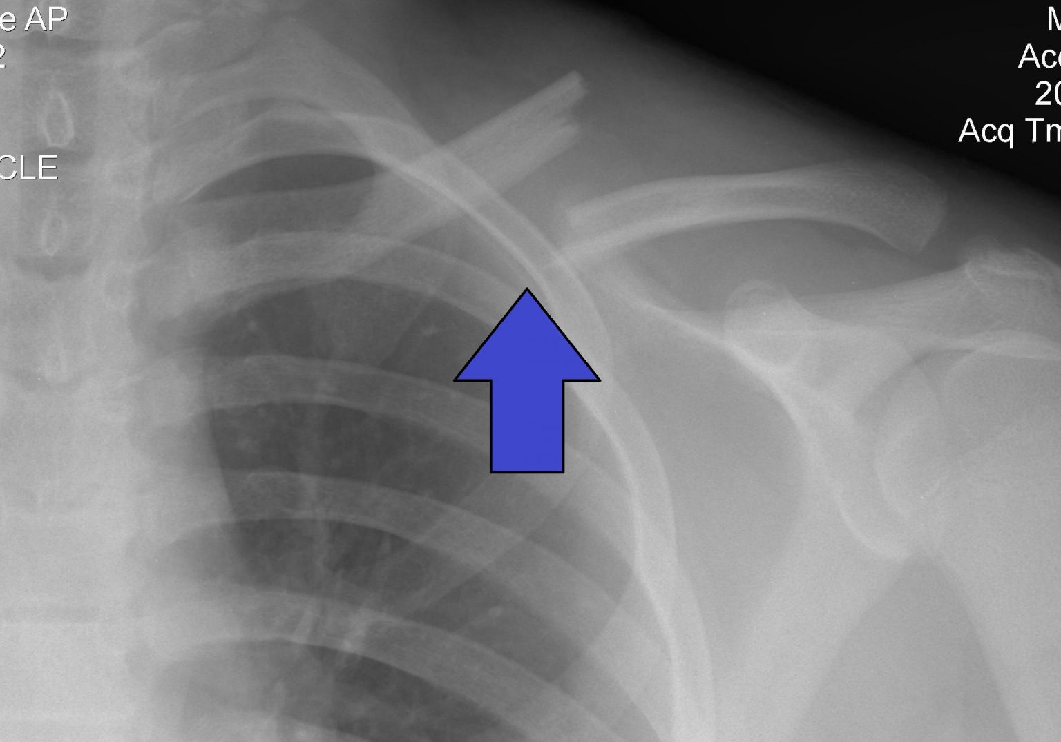 What is the Clavicle (Collar Bone)? - First Aid for Free