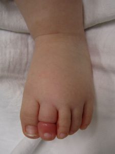 What is Toe-tourniquet Syndrome? - First Aid for Free