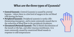 Is Cyanosis an Emergency? - First Aid for Free