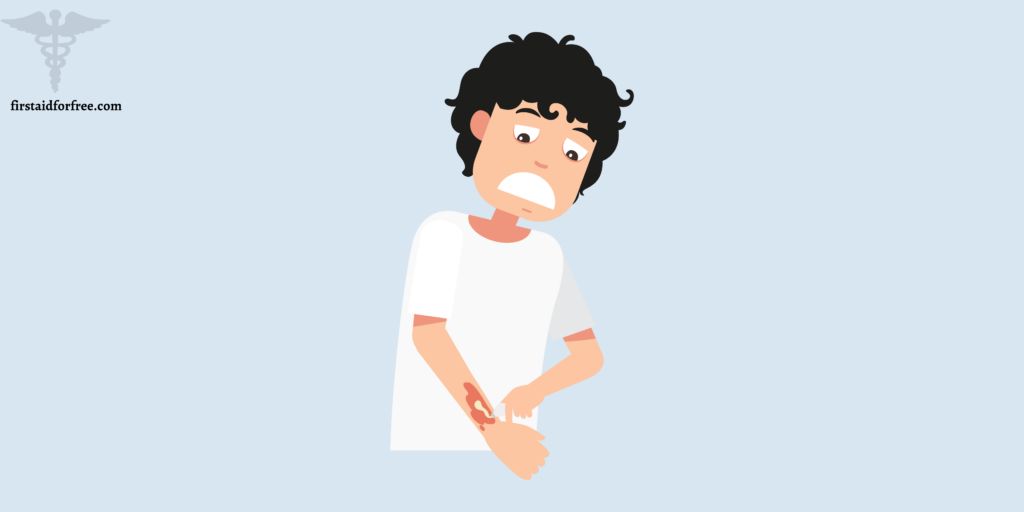 First Aid For Thermal Contact Burns: 4 Treatment Tips - First Aid for Free
